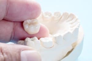 How Long Should Tooth Sensitivity Last After a Crown? - Thomas Blake, DDS